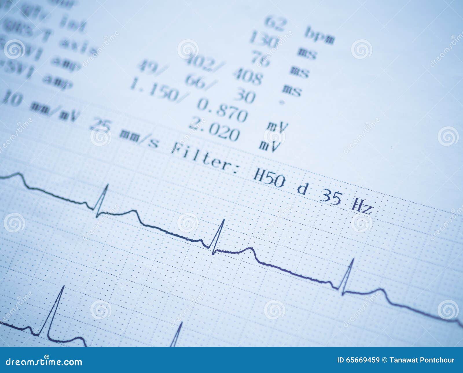 Close Up Of An Electrocardiogram In Paper Form. ECG Or EKG Record Paper ...