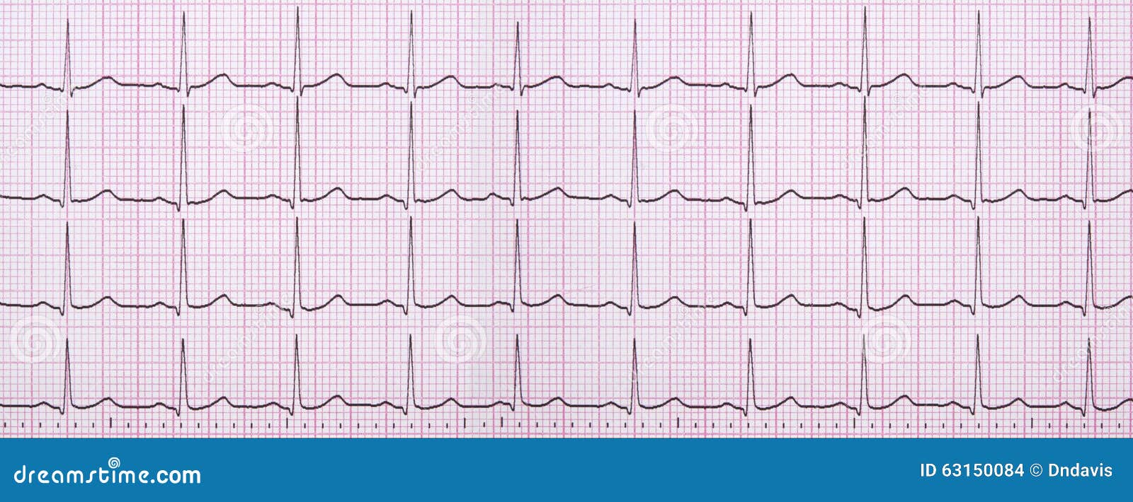Close Up of a Electrocardiograph Also Known As a EKG Stock Photo ...