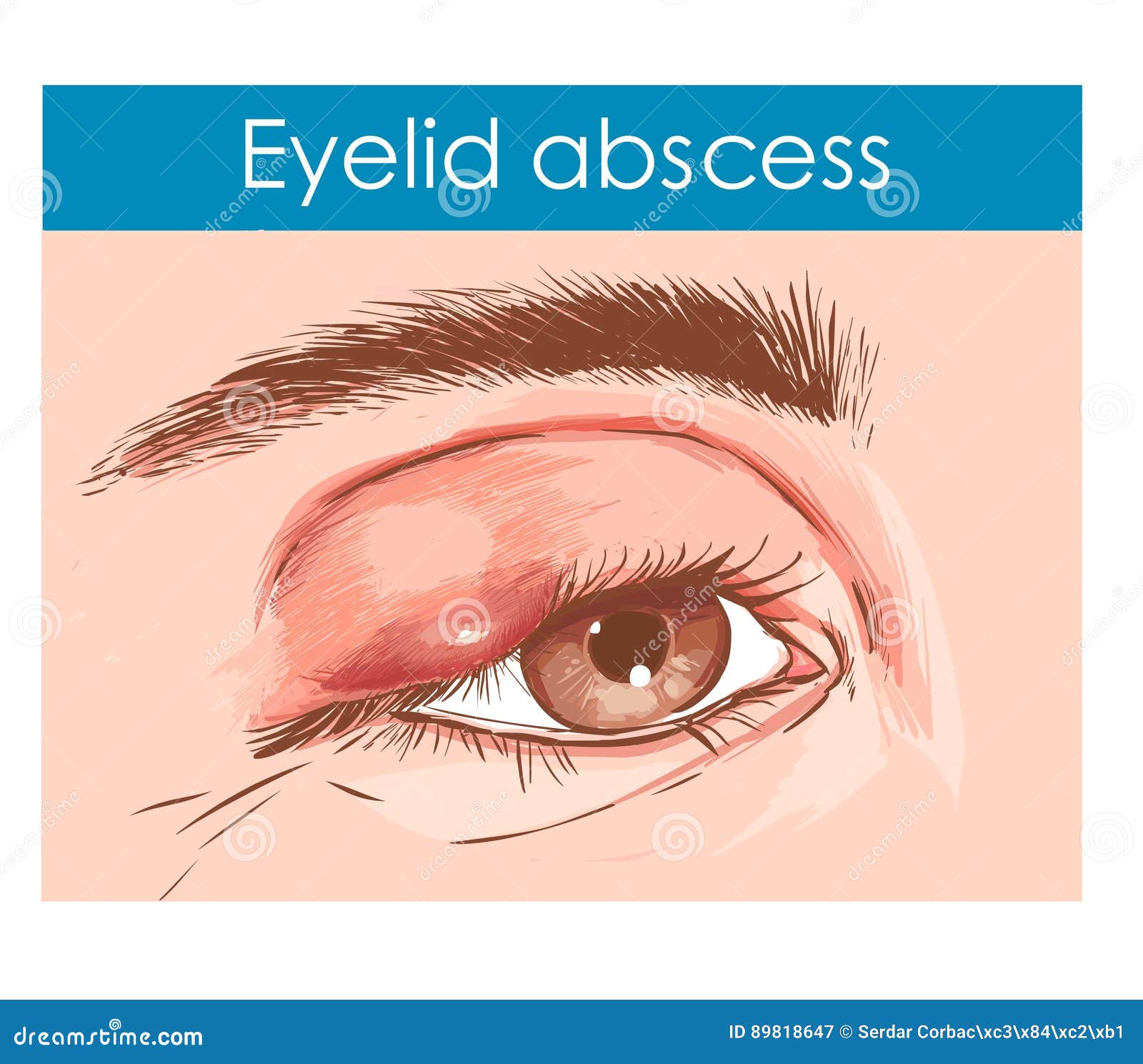 Abscess Cartoons, Illustrations & Vector Stock Images - 197 Pictures to ...