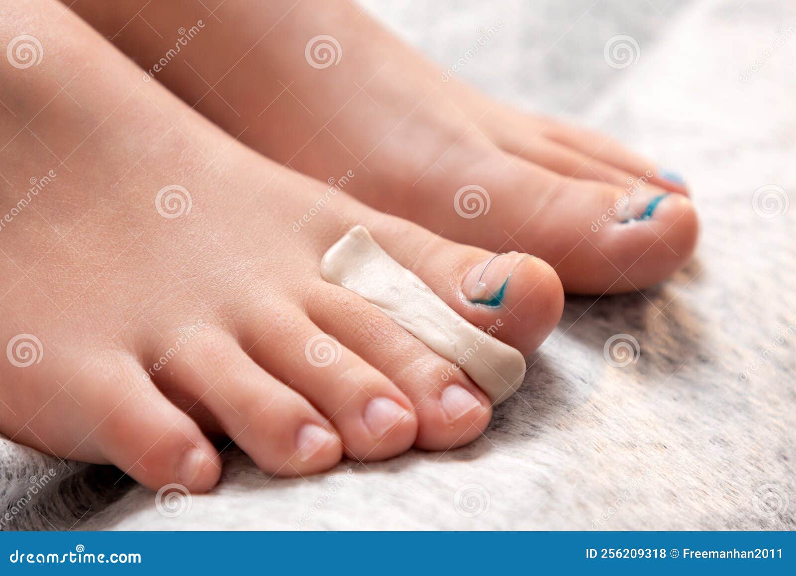 A Close-up of the Feet with a Bracket on the Nail and a Silicone ...