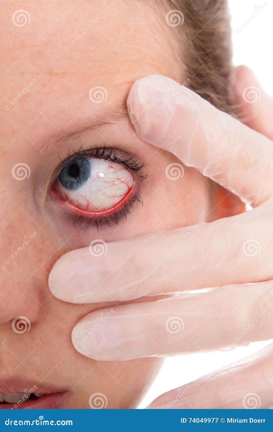 Close Up from a Female Eye with Conjunctivitis Stock Image - Image of ...