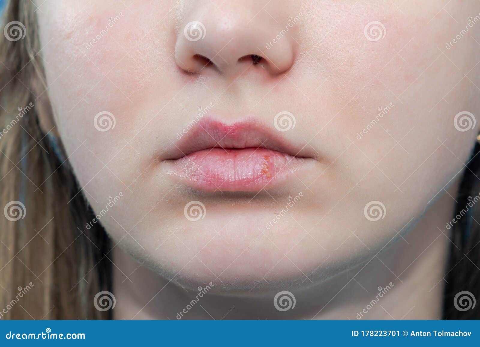 Close-up of Female Lips Suffering from Herpes. Lips Virus Infected ...