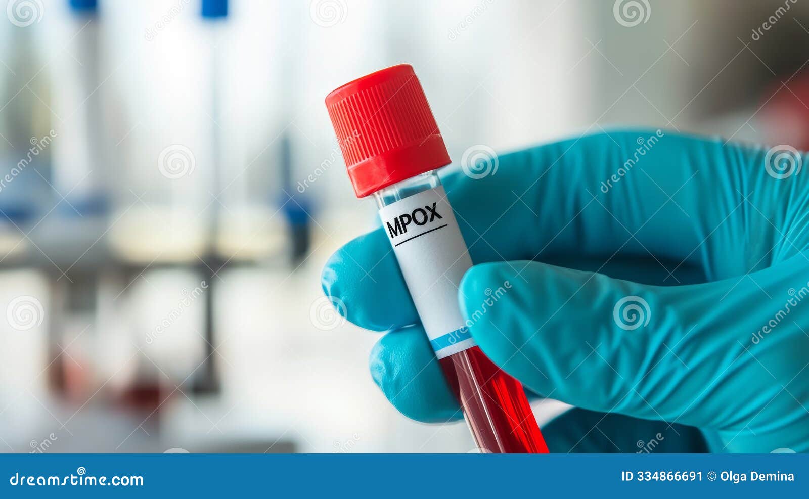 Close-up of a Gloved Hand Holding a Blood Sample Labeled MPOX in a ...