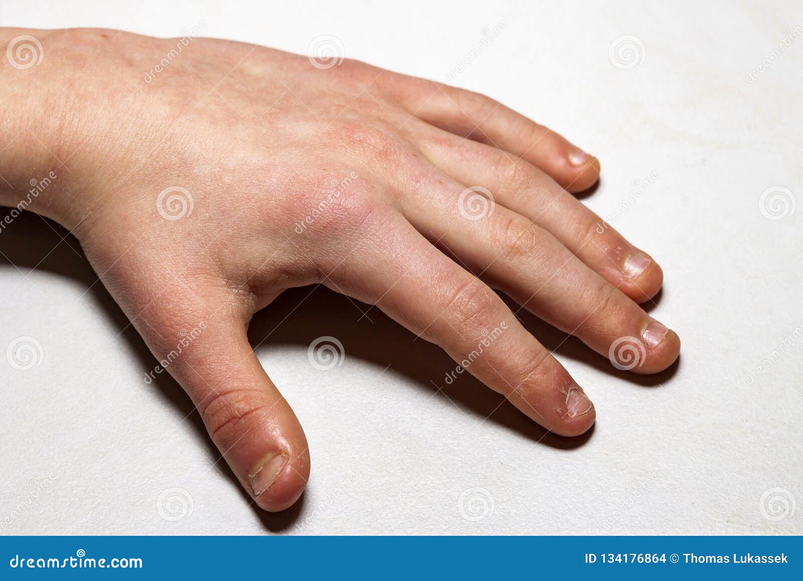 Close Up of Hand with Bitten Finger and Fingernails. Stock Photo ...