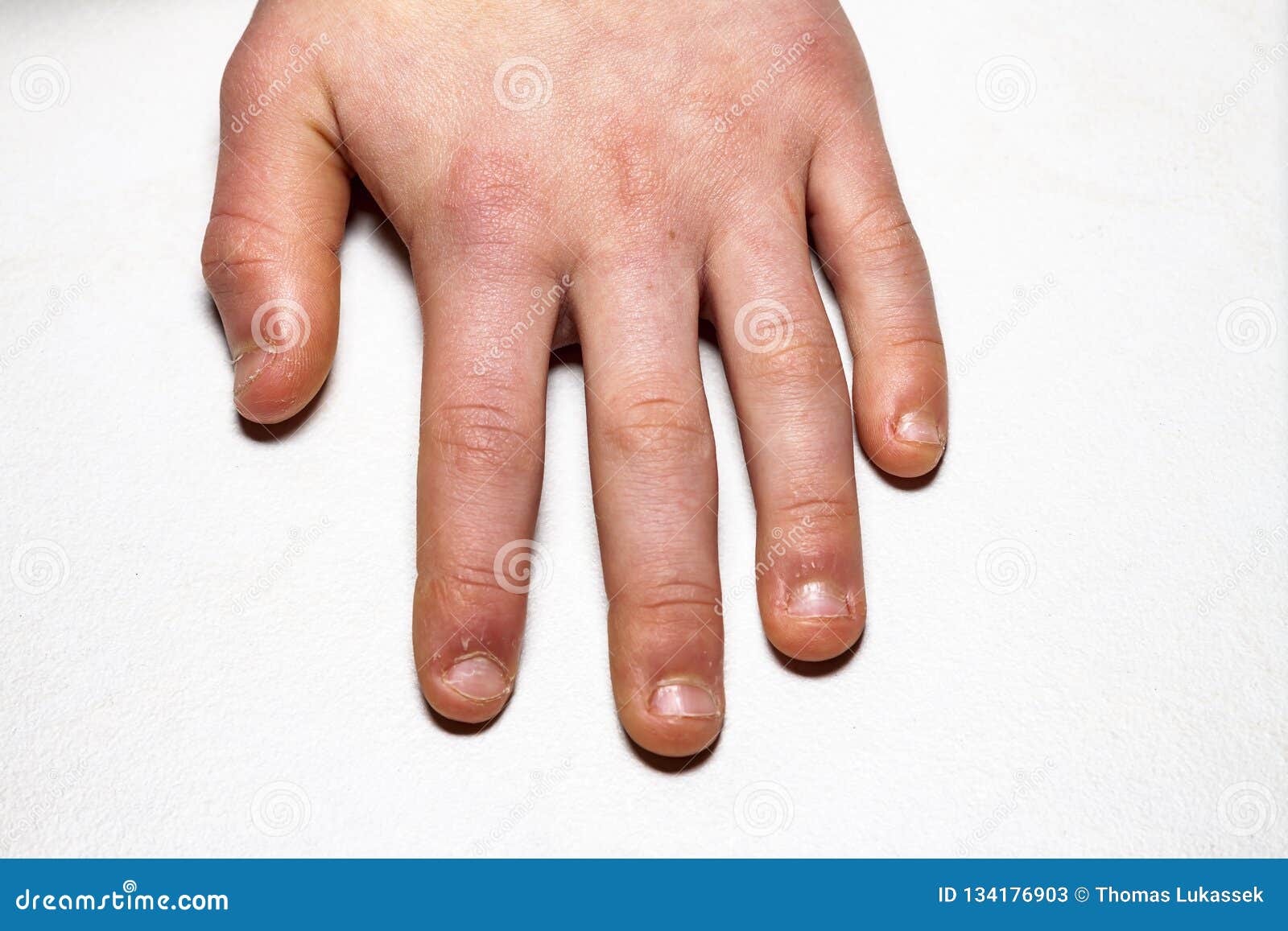 Close Up of Hand with Bitten Finger and Fingernails. Stock Image ...