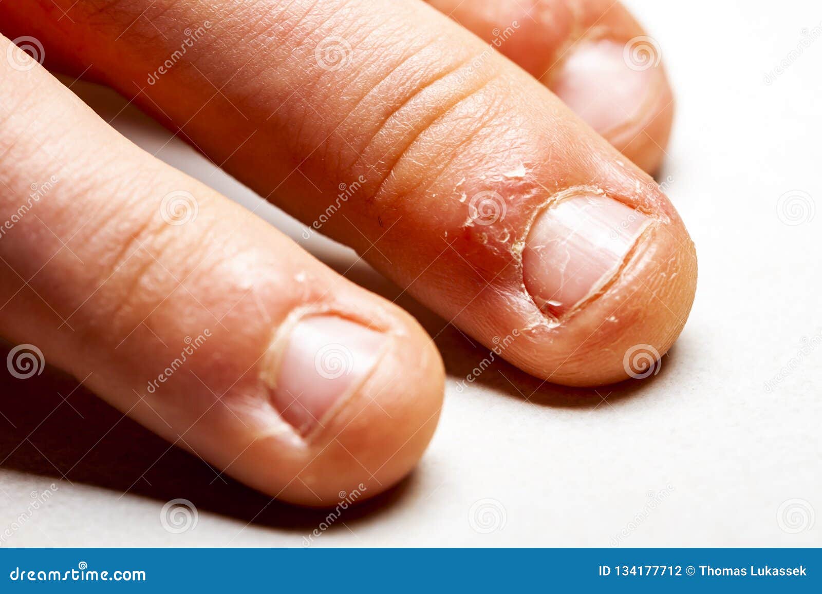 Close Up of Hand with Bitten Finger and Fingernails. Stock Photo ...