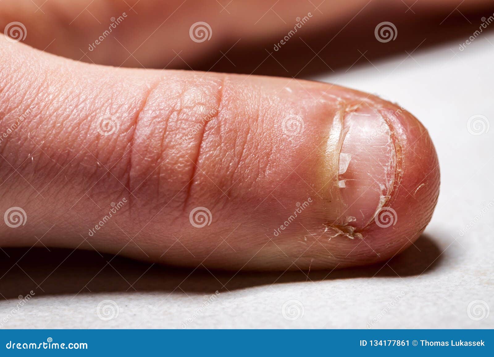 Close Up of Hand with Bitten Finger and Fingernails. Stock Image ...
