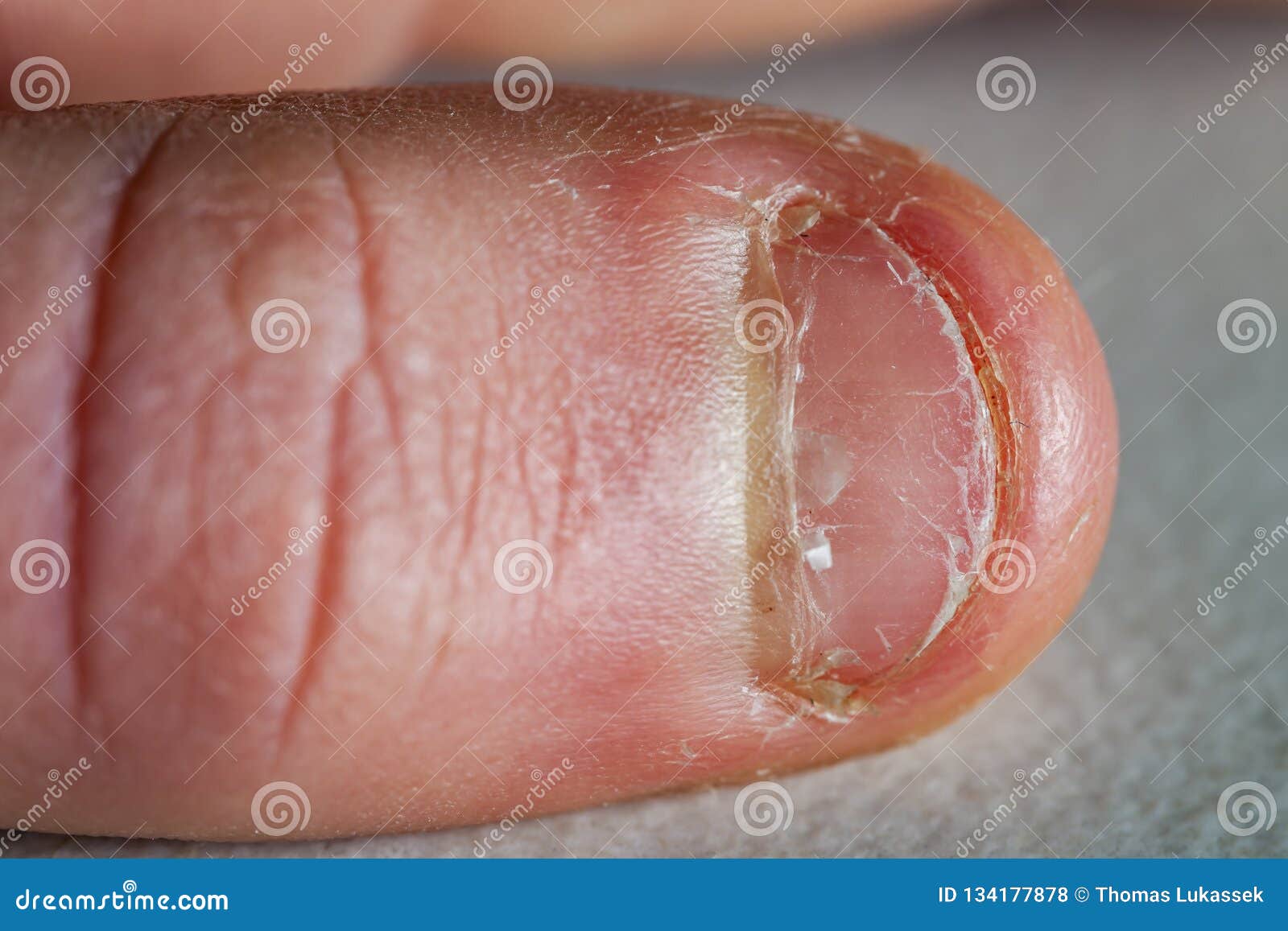 Close Up of Hand with Bitten Finger and Fingernails. Stock Photo ...