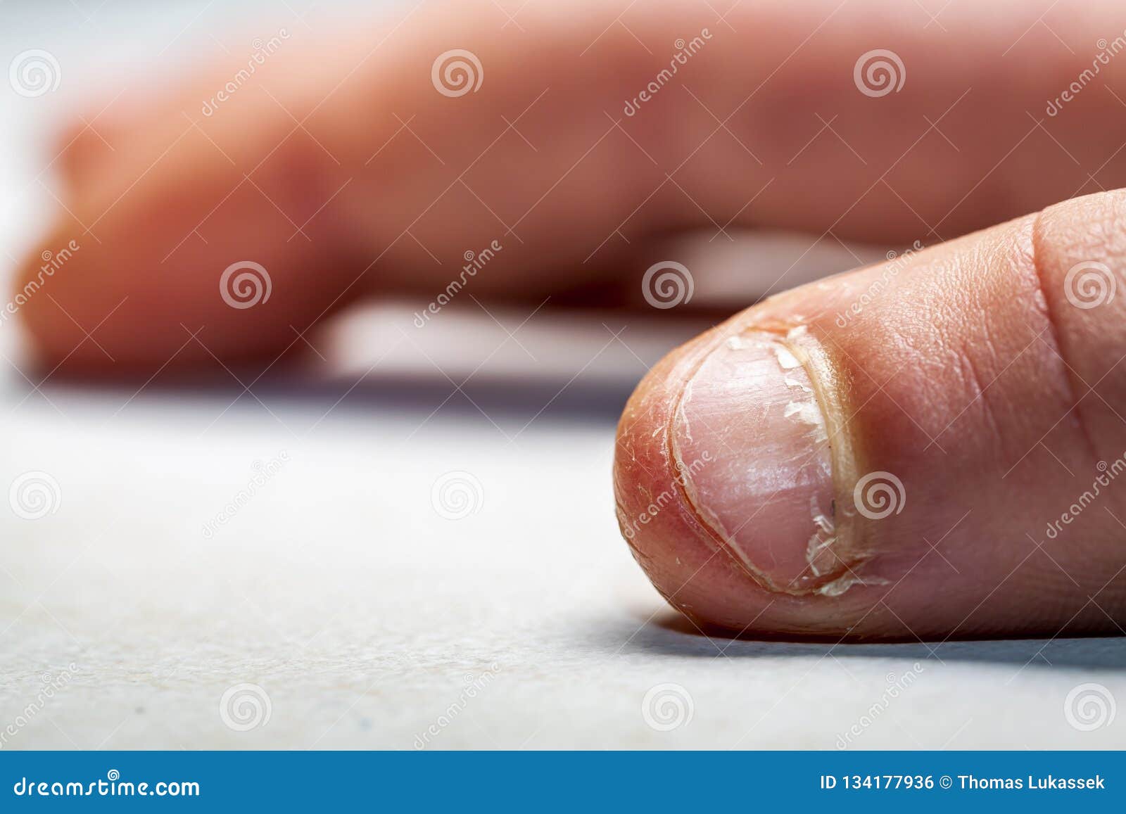 Close Up of Hand with Bitten Finger and Fingernails. Stock Photo ...