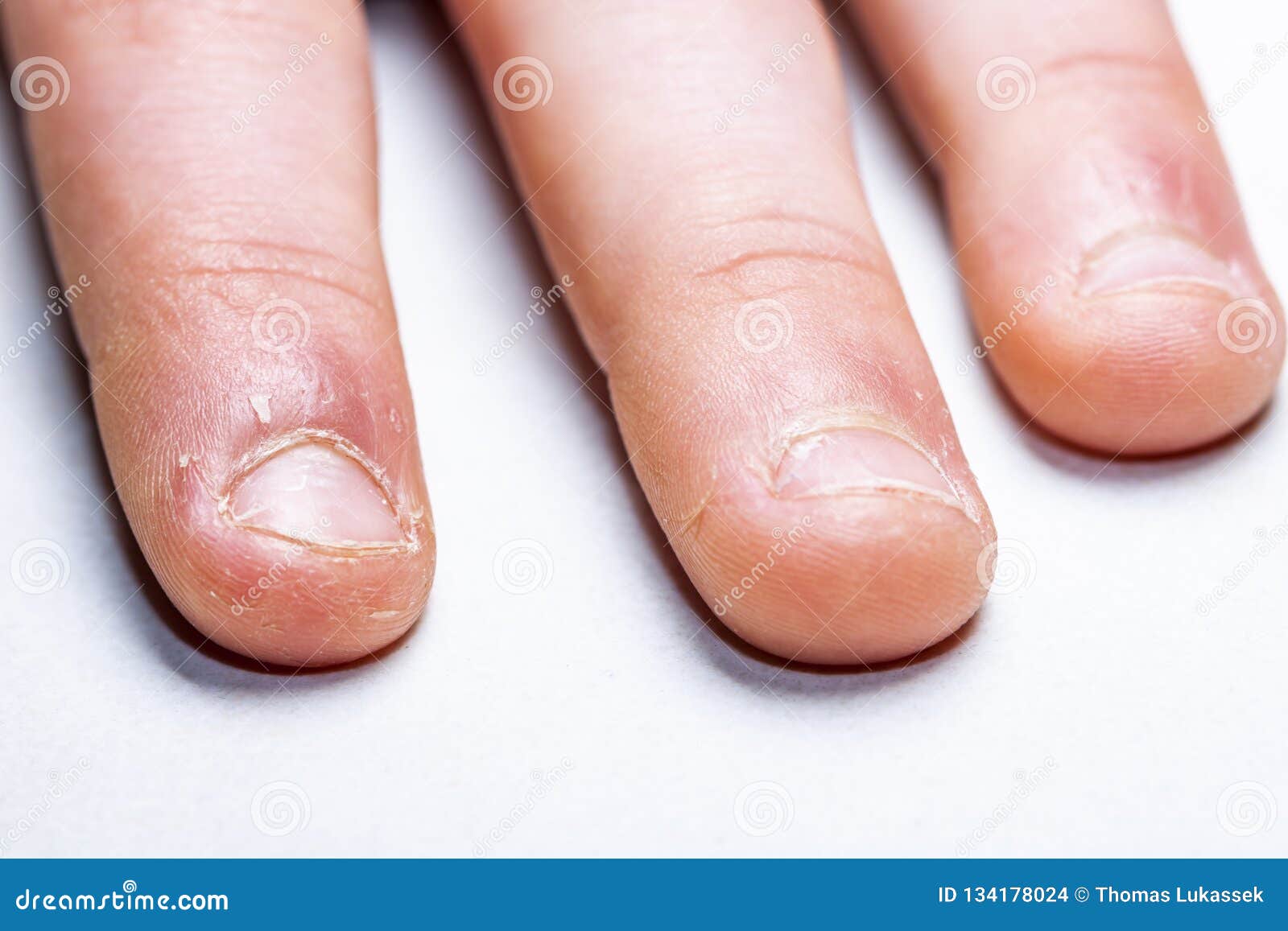 Close Up of Hand with Bitten Finger and Fingernails. Stock Photo ...