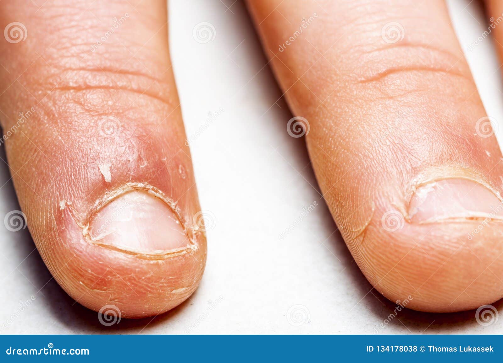 Close Up of Hand with Bitten Finger and Fingernails. Stock Photo ...