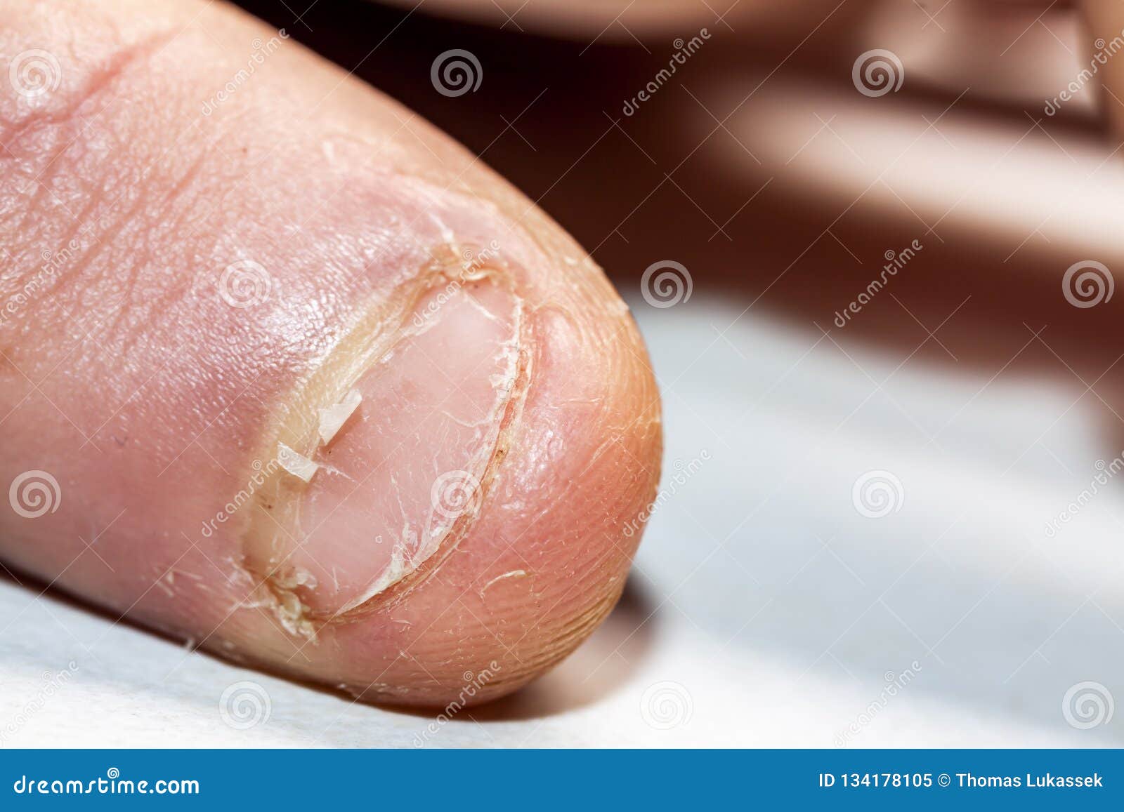 Close Up of Hand with Bitten Finger and Fingernails. Stock Image ...