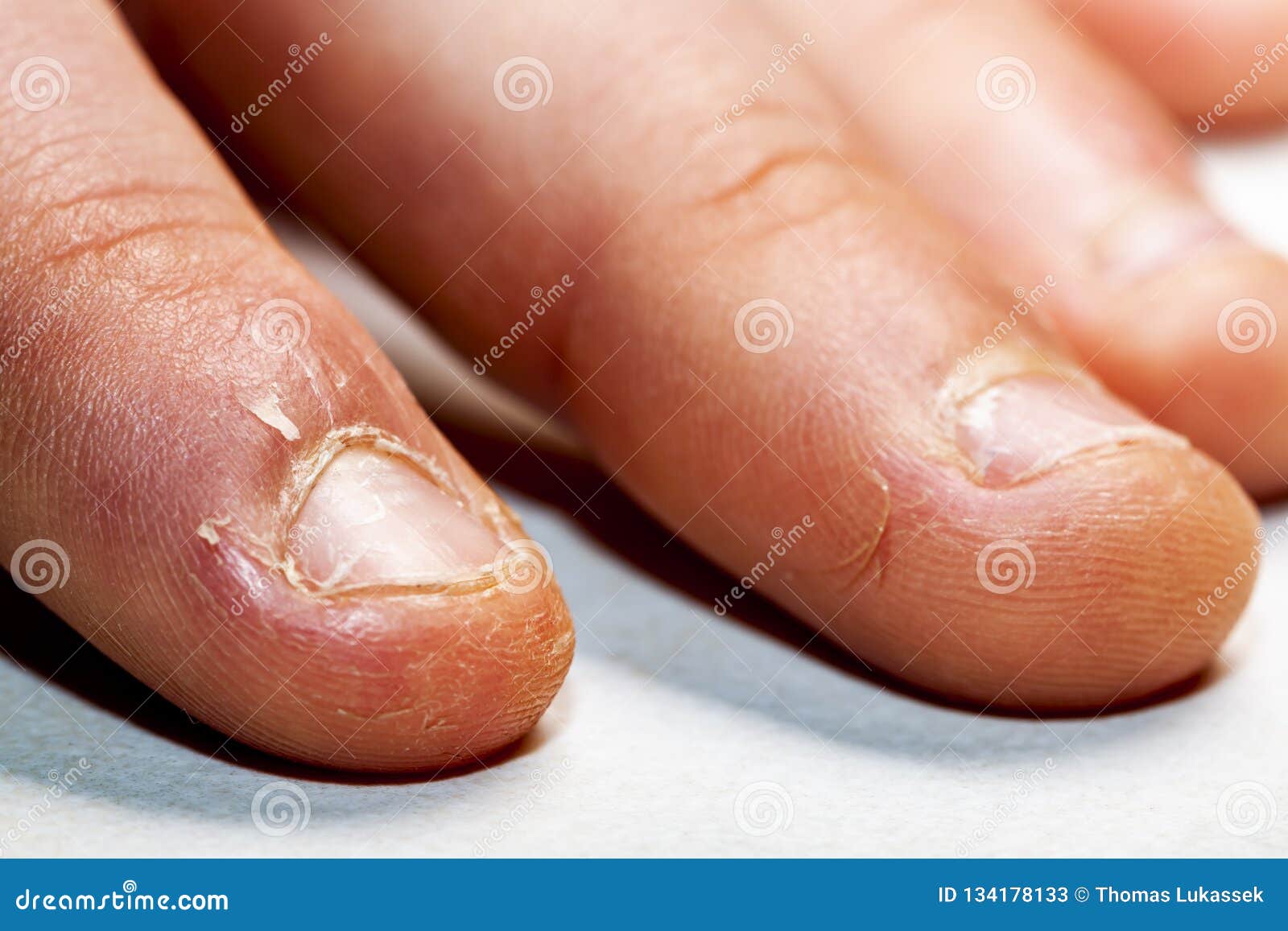 Close Up of Hand with Bitten Finger and Fingernails. Stock Image ...