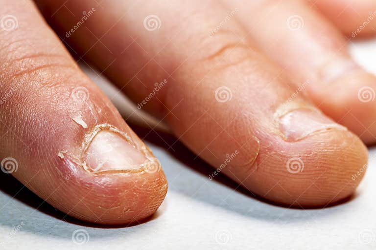 Close Up of Hand with Bitten Finger and Fingernails. Stock Image ...