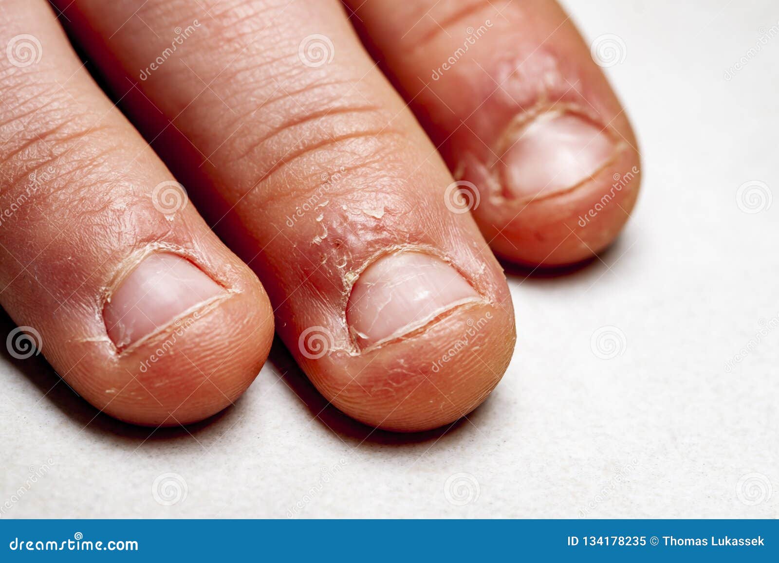 Close Up of Hand with Bitten Finger and Fingernails. Stock Image ...