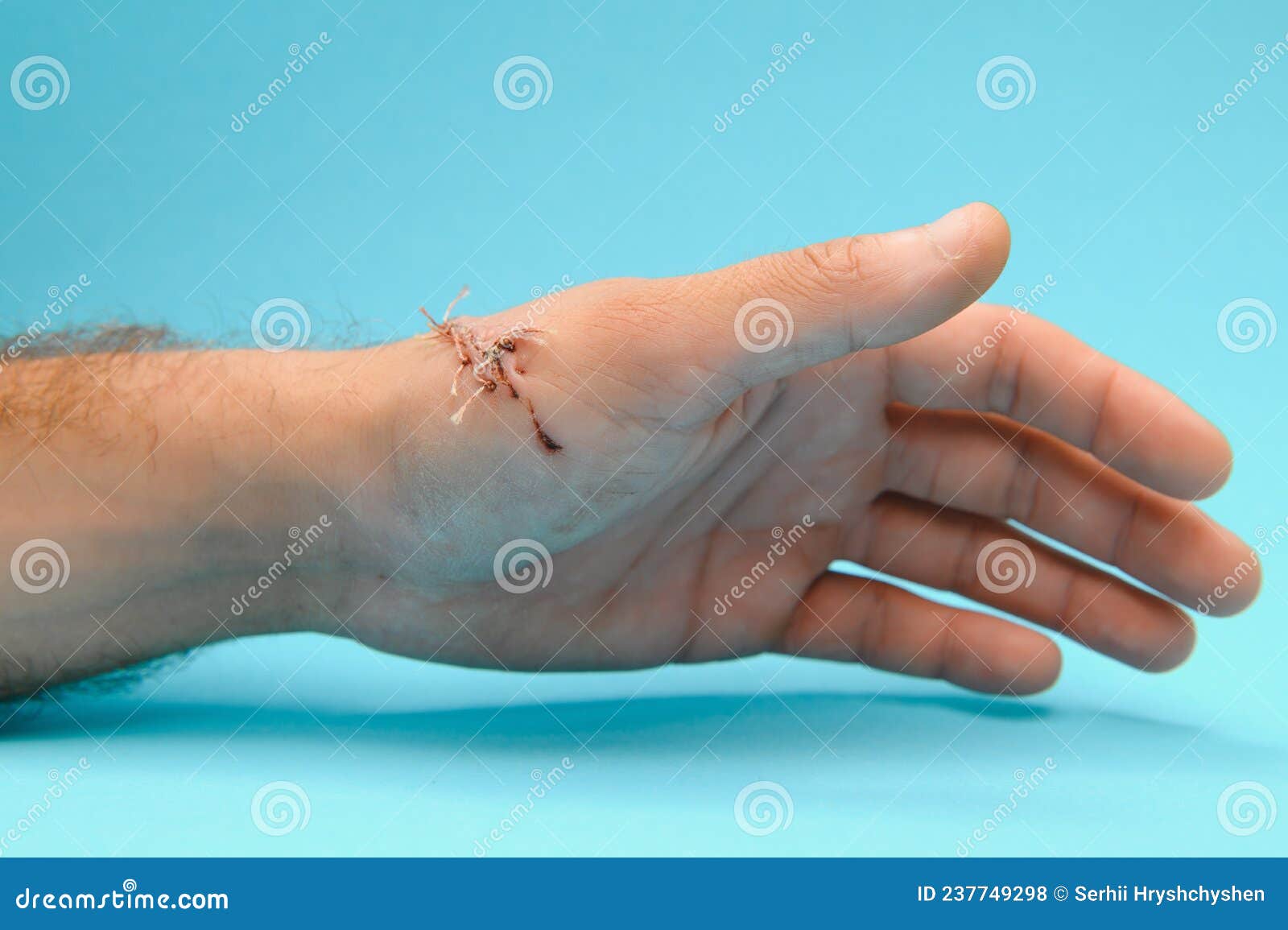 Close-up of a Hand Wound with Stitches Stock Photo - Image of body ...