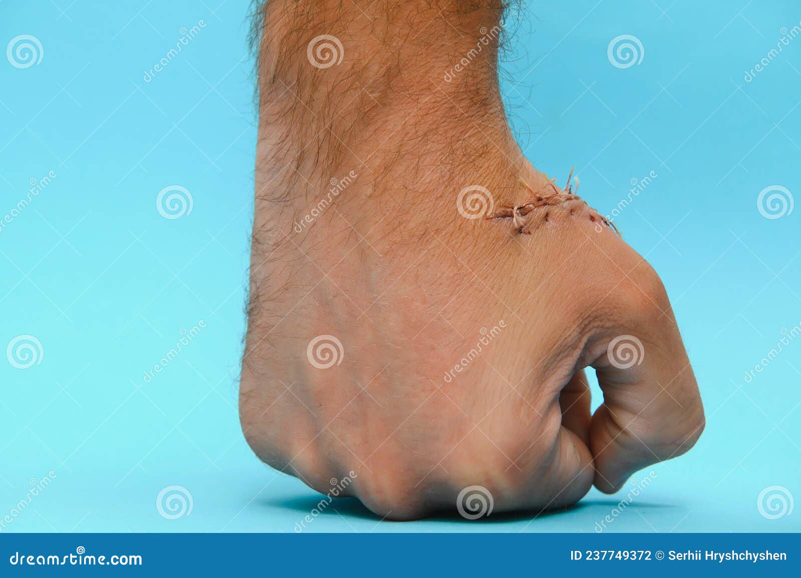 Close-up of a Hand Wound with Stitches Stock Photo - Image of medicine ...