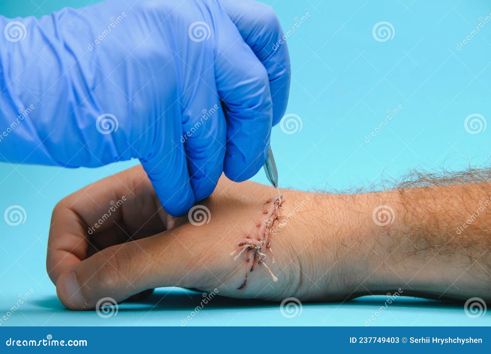 Close-up of a Hand Wound with Stitches Stock Image - Image of clinic ...