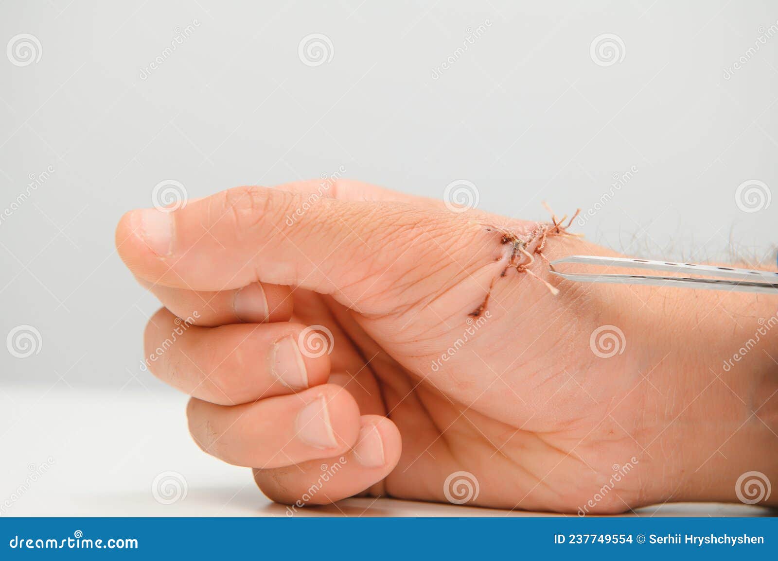 Close-up of a Hand Wound with Stitches Stock Photo - Image of medical ...