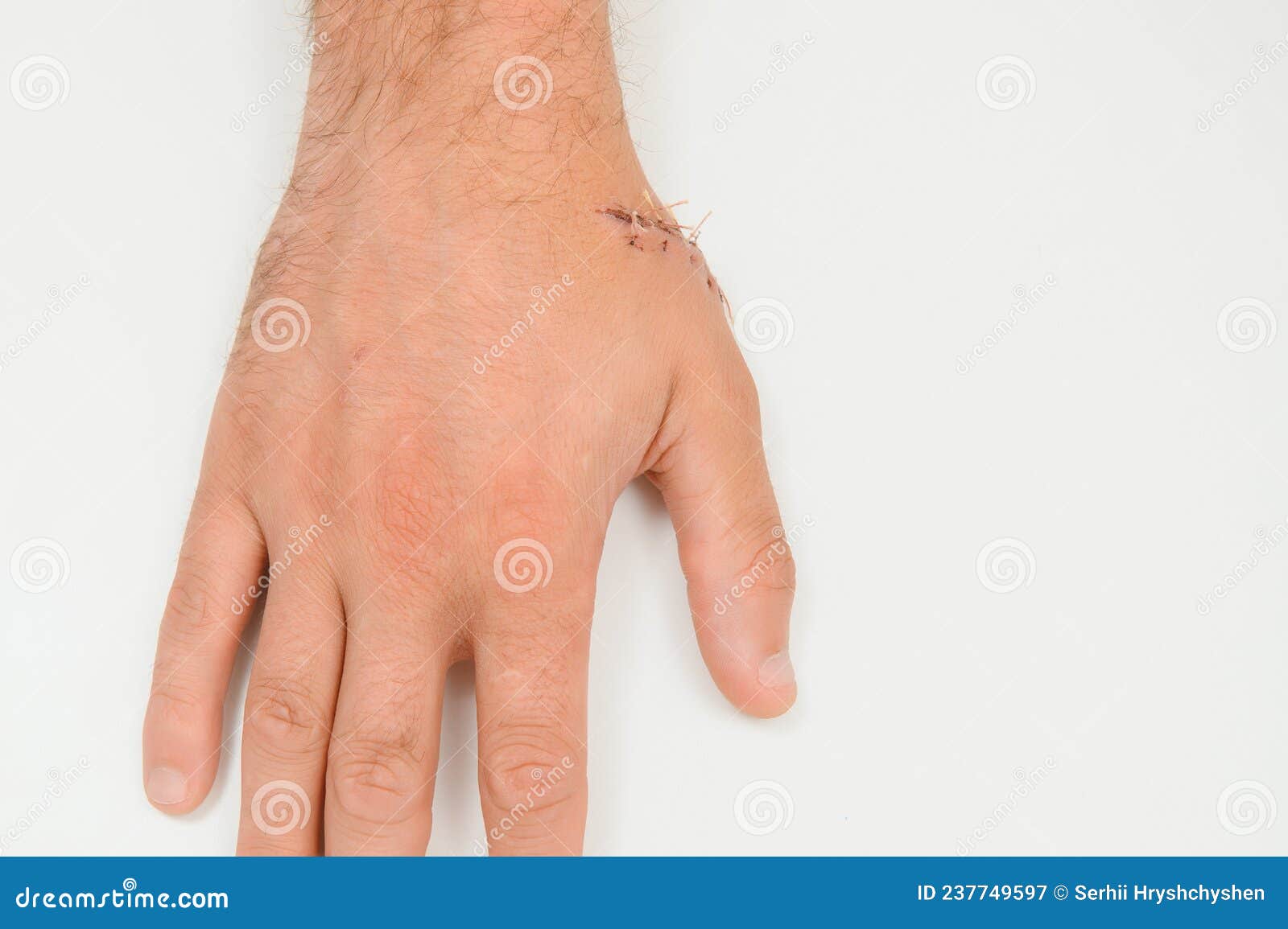 Close-up of a Hand Wound with Stitches Stock Image - Image of finger ...