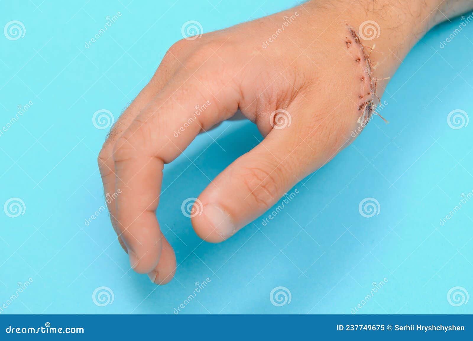 Close-up of a Hand Wound with Stitches Stock Image - Image of clinic ...