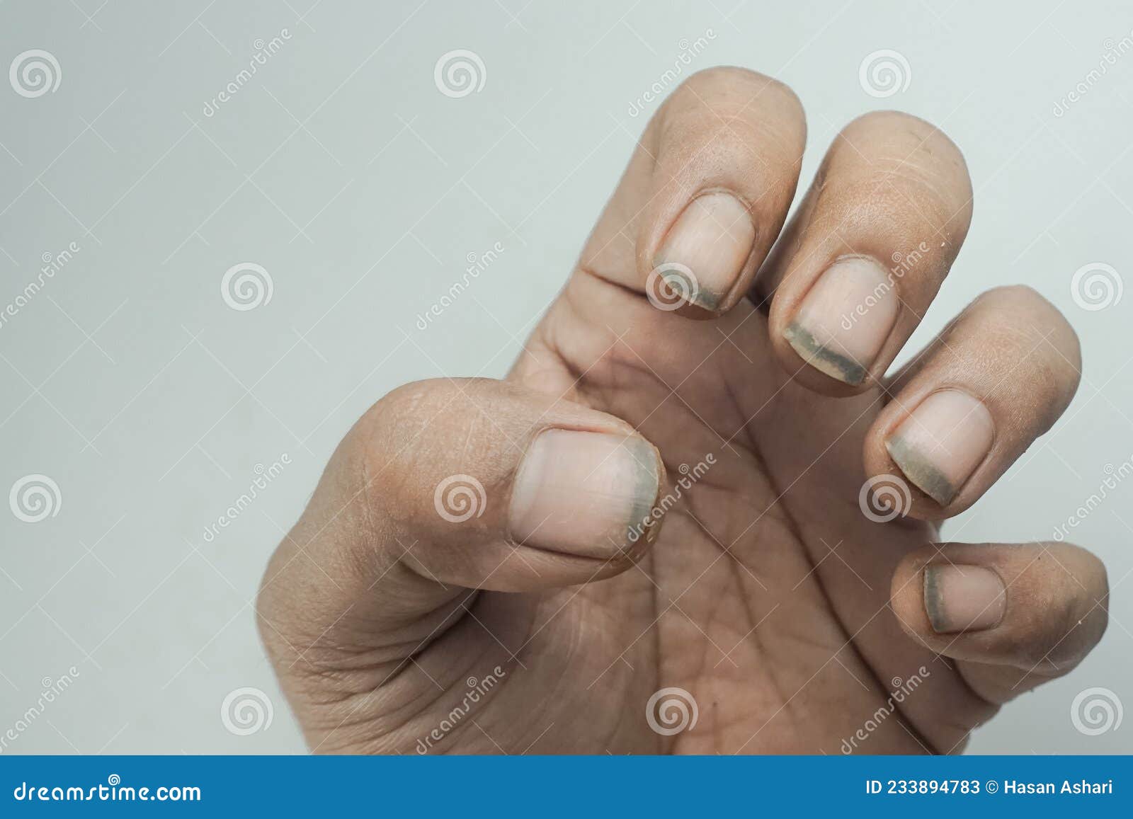 Close-up of Hands with Dirty Nails. Dirty Black Nails Stock Image ...