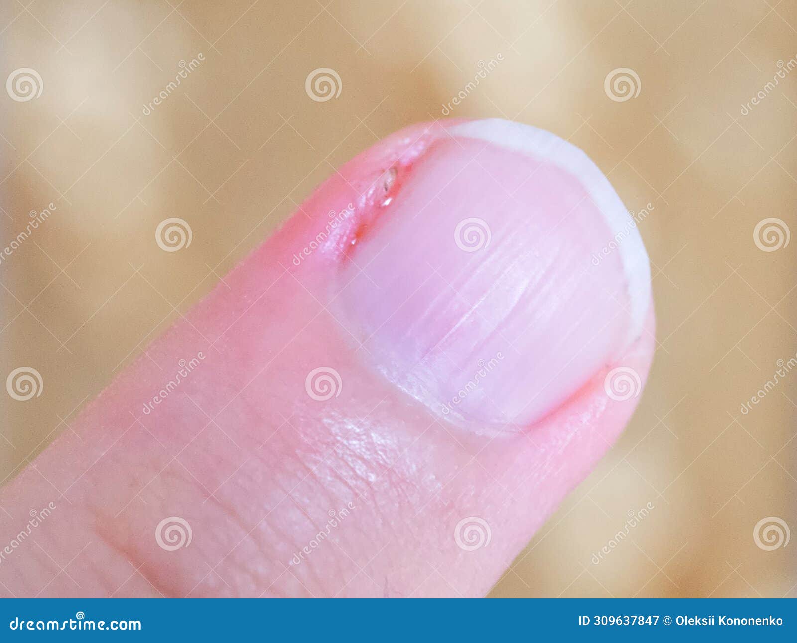 A Close-up of a Human Finger Showing a Healing Cut Stock Image - Image ...