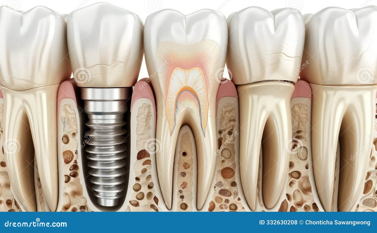 Close-up Illustration of a Dental Implant Replacing a Missing Tooth ...