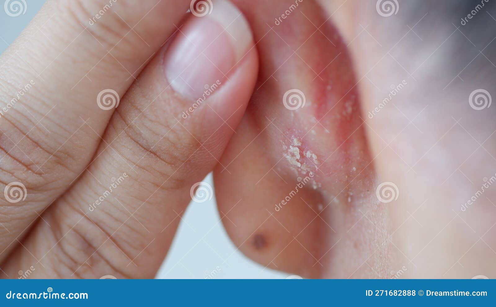 Plaque Psoriasis Ear