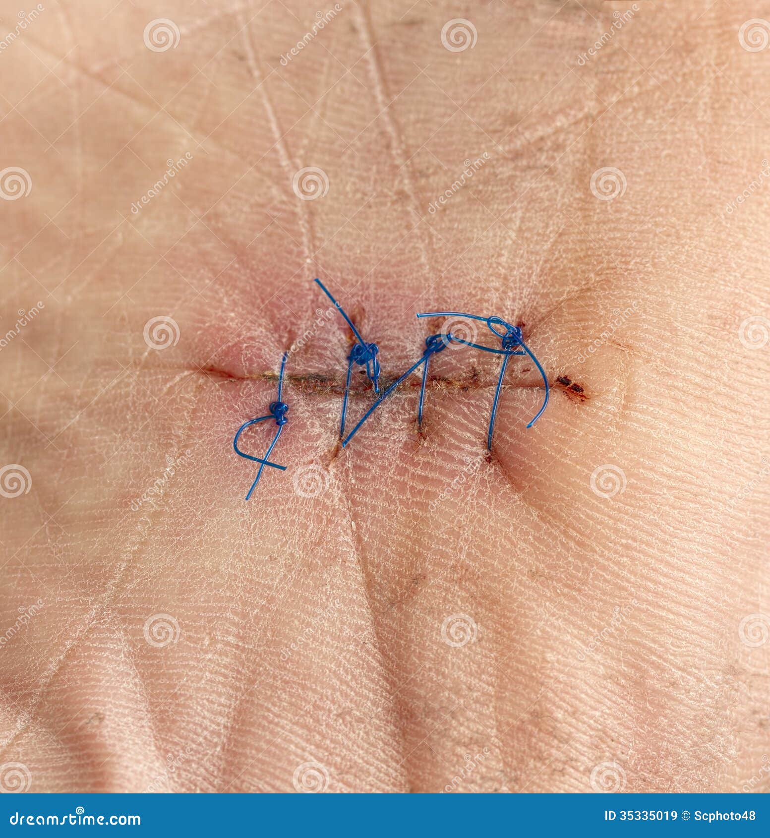 Close up image of sutures stock image. Image of incision - 35335019