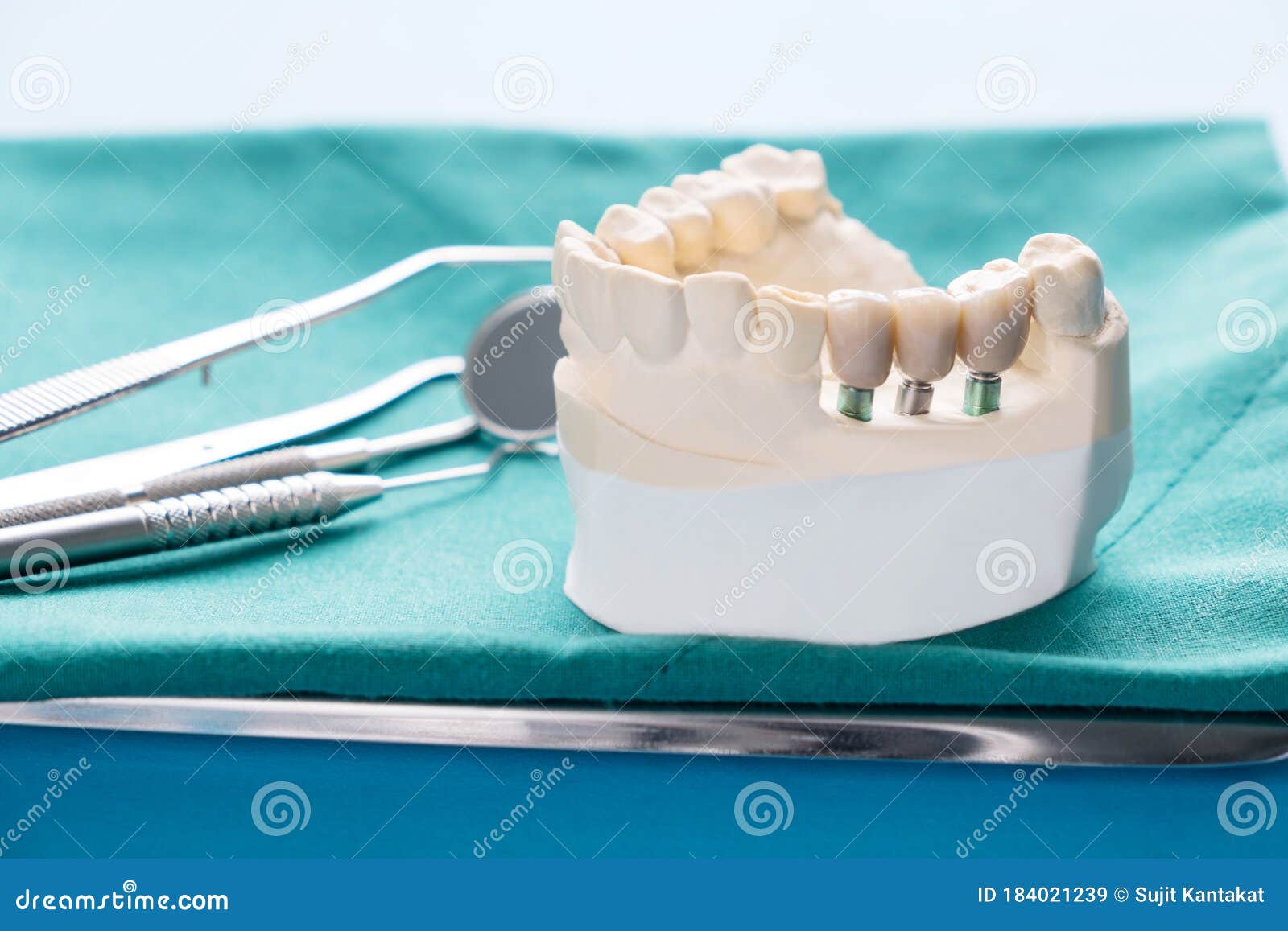 Implant and Prosthodontic Model. Stock Image - Image of single, health ...