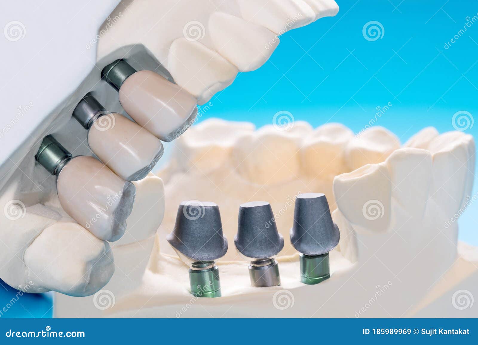 Close Up Implant and Prosthodontic Model. Stock Image - Image of ...