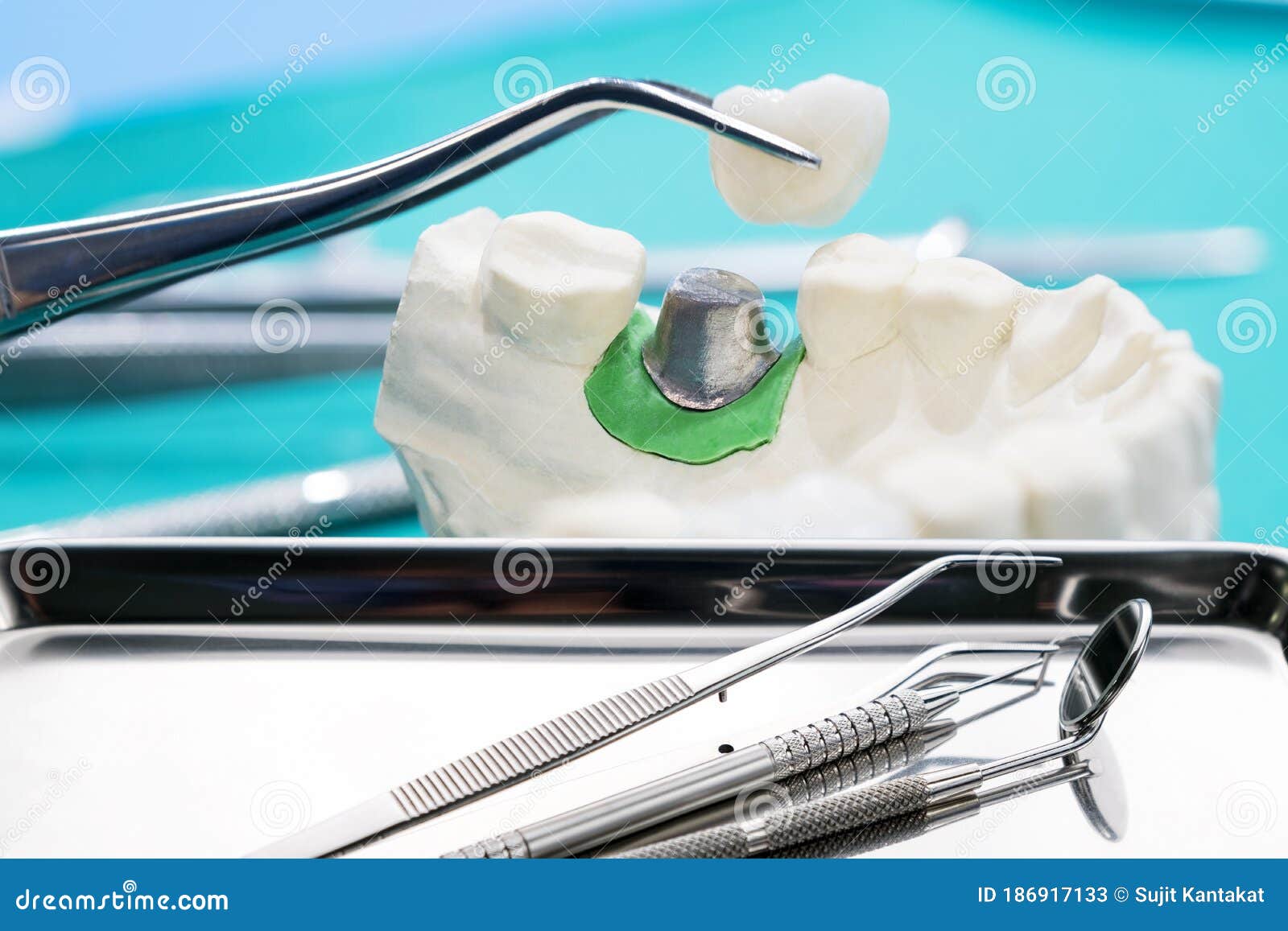 Close Up Implant and Prosthodontic Model. Stock Image - Image of ...
