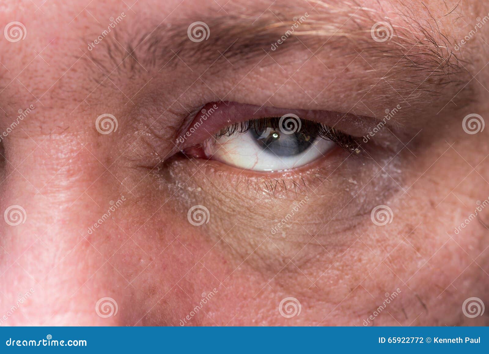 Close up of infected eye stock photo. Image of eyelid - 65922772