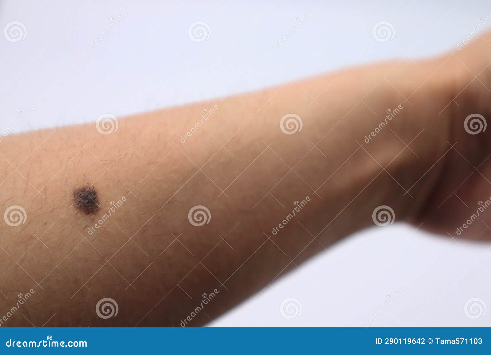 Large Mole Close-up. Macro Shot Of Benign Skin Lesion On Caucasian ...