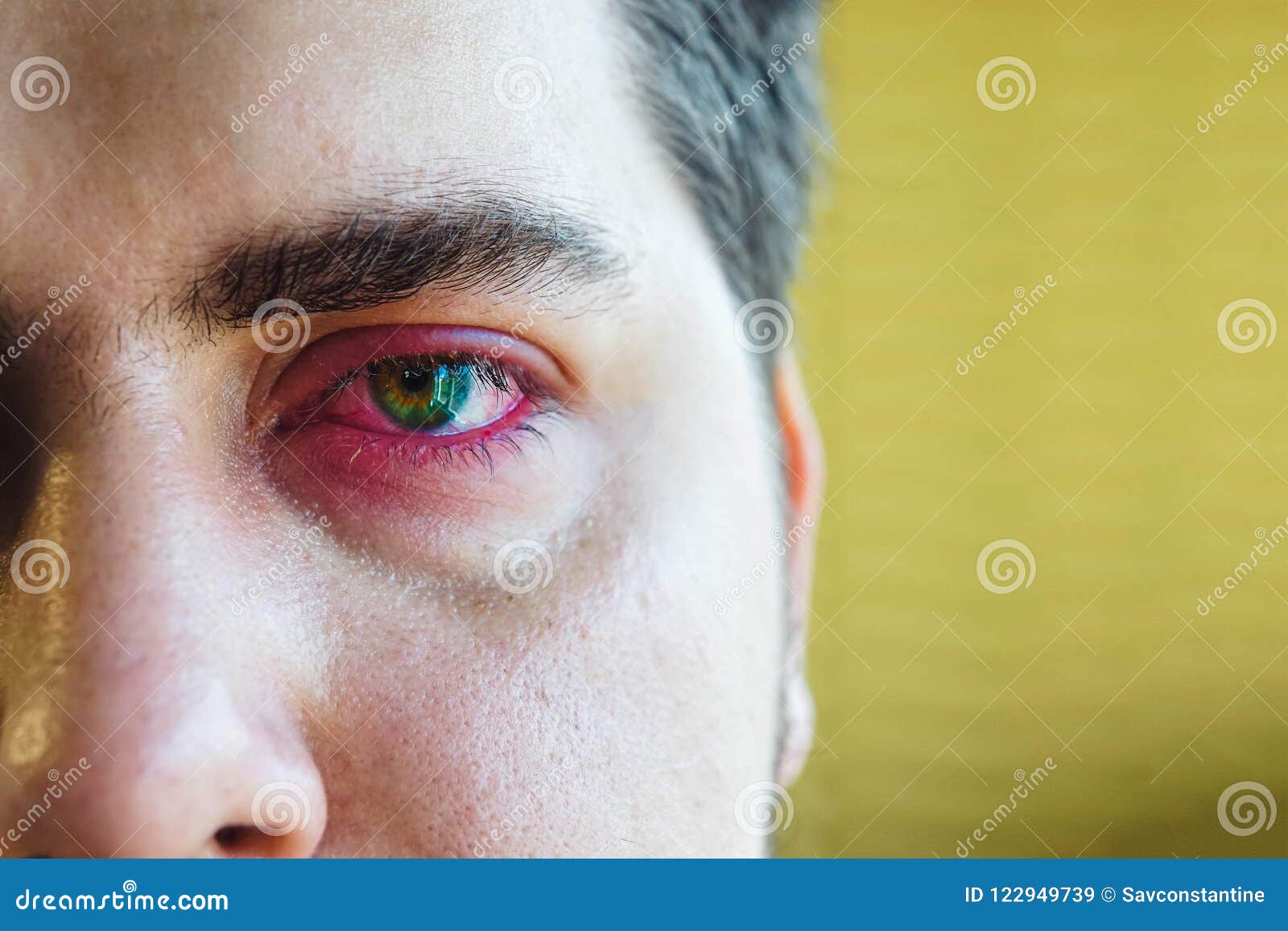 Eyelid abscess stock image. Image of closeup, eyelid - 122949739