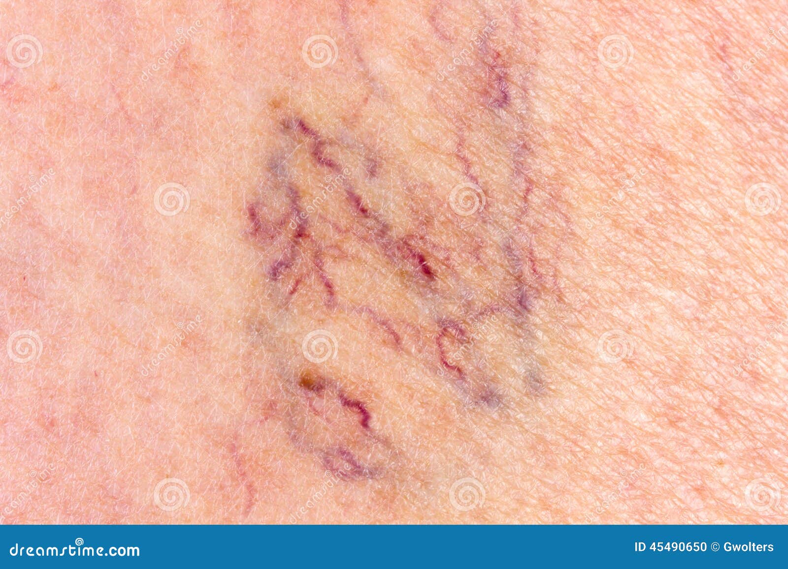 Close-up of Leg with Varicose Veins Stock Photo - Image of beauty ...