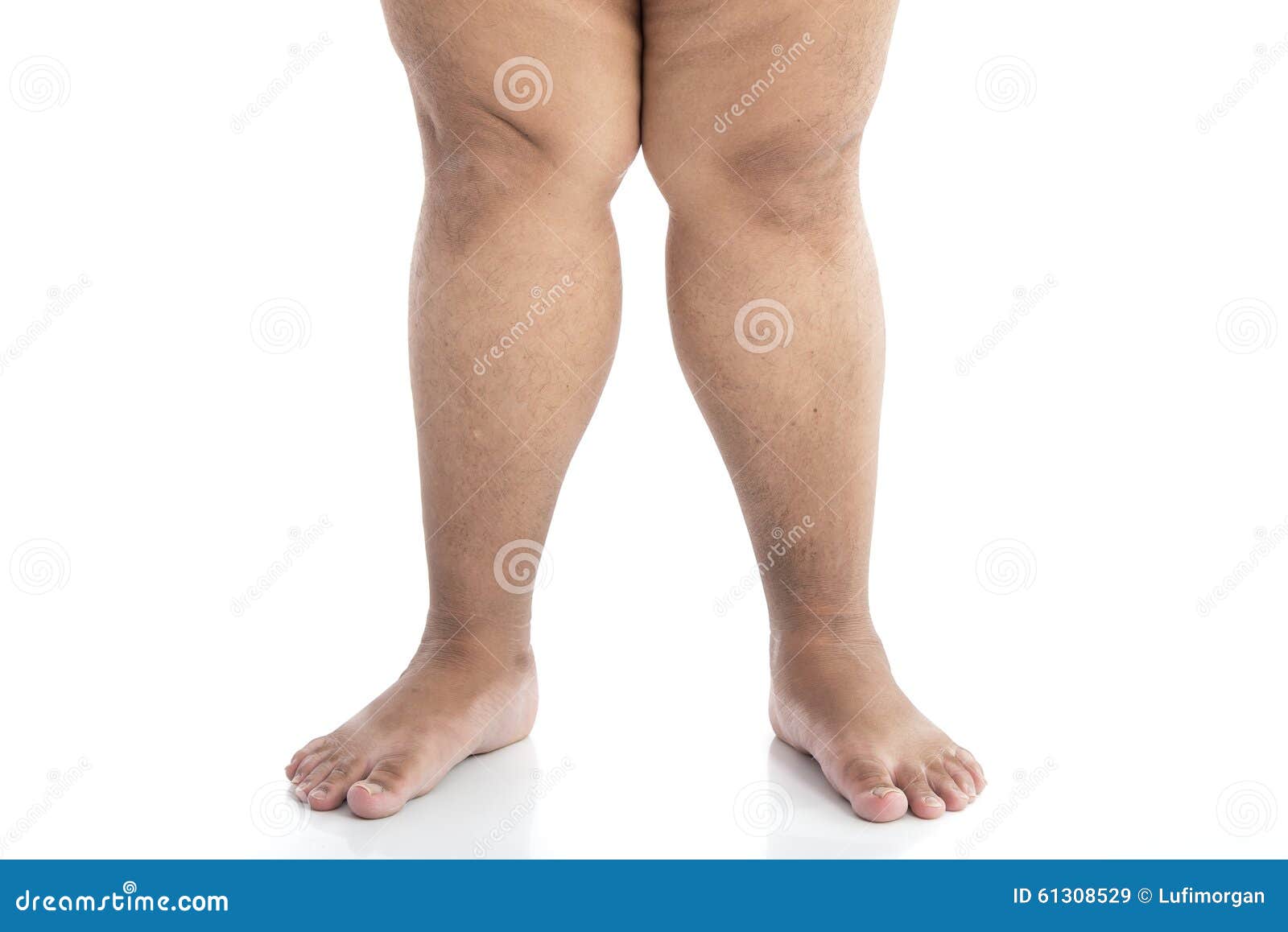 Close Up of Legs with Overweight Standing Stock Image - Image of ...