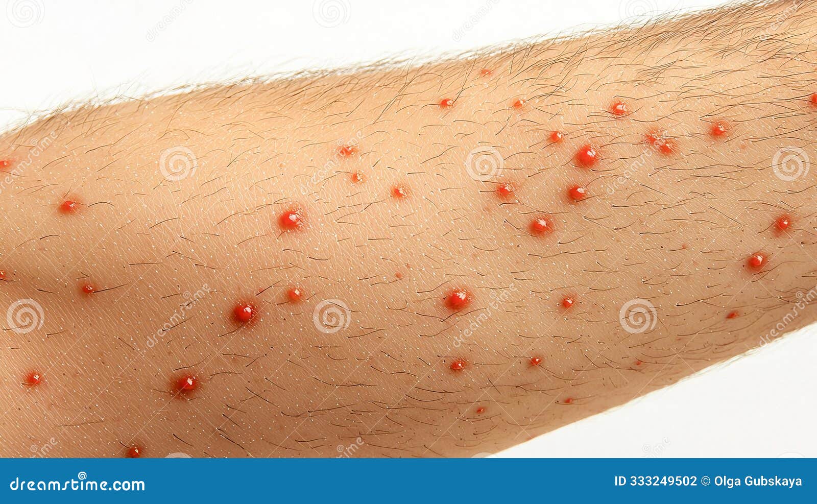 Male Arm with Red Pustules. Monkeypox. AI Generated Stock Photo - Image ...