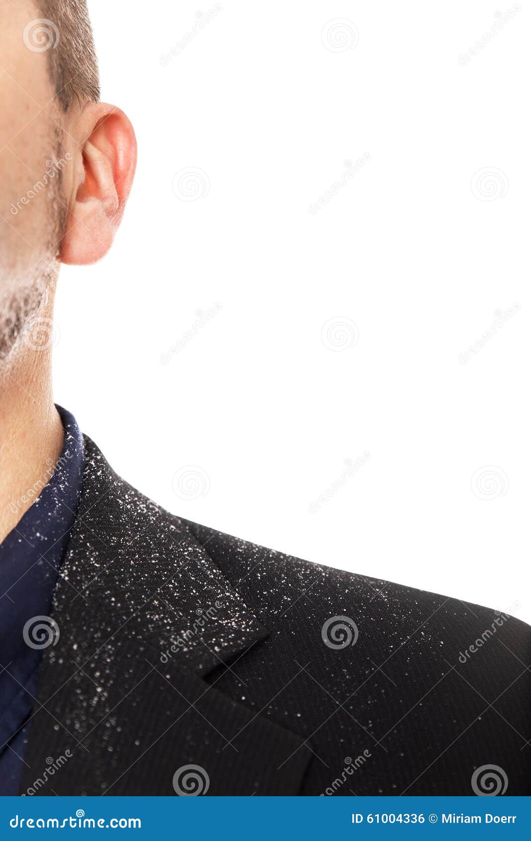 Close Up From A Man With A Dandruff Problem Stock Photo - Image of ...