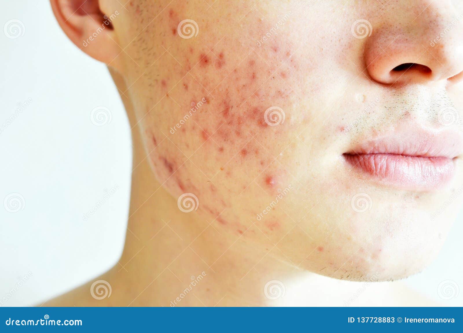 Close Up of Man with Problematic Skin and Scars from Acne. Stock Image ...