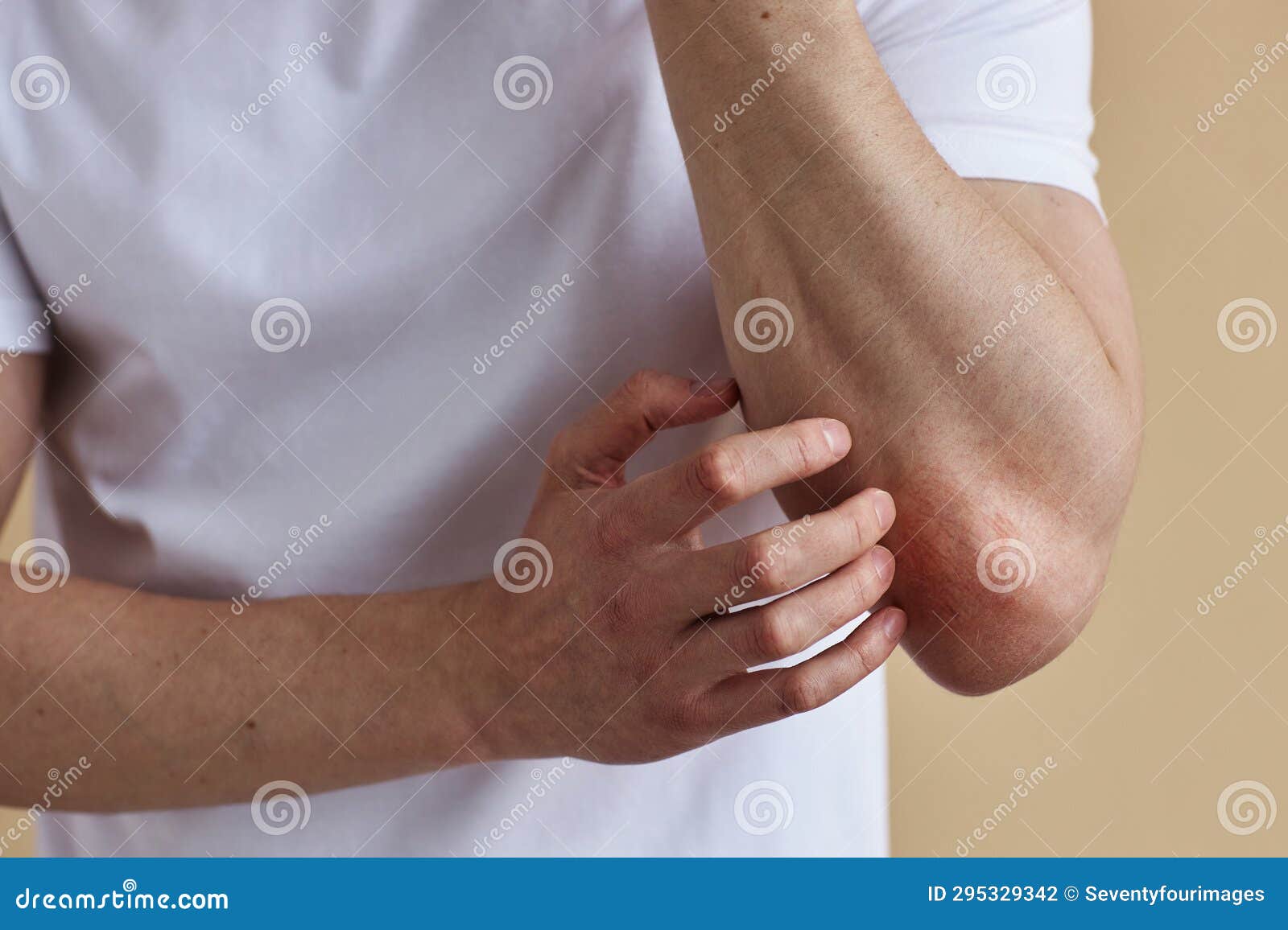 Close Up of Man Scratching Elbow Rash or Skin Condition Stock Photo ...