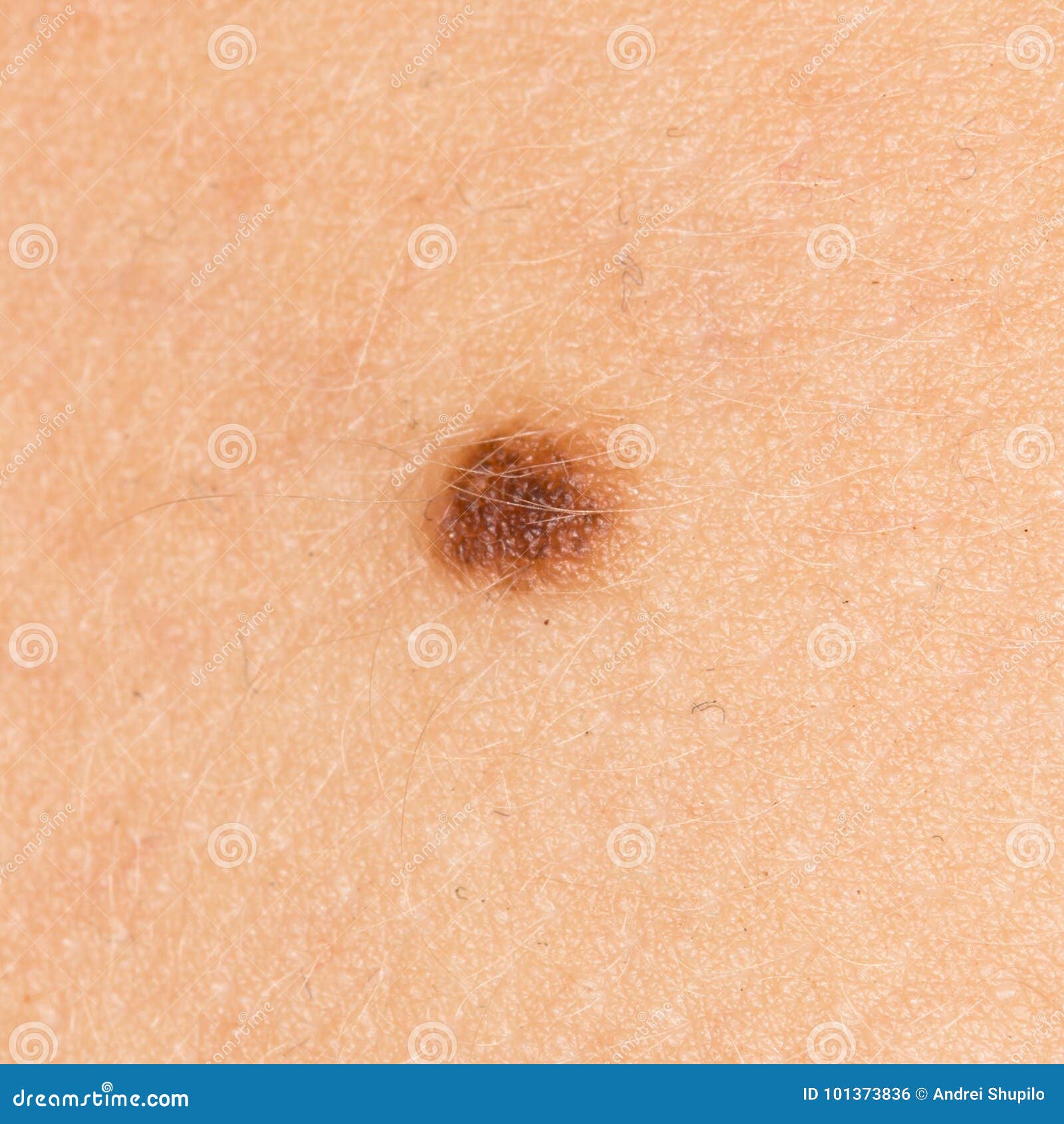 Close Up of Mole on Human Skin Stock Photo - Image of beauty, spot ...