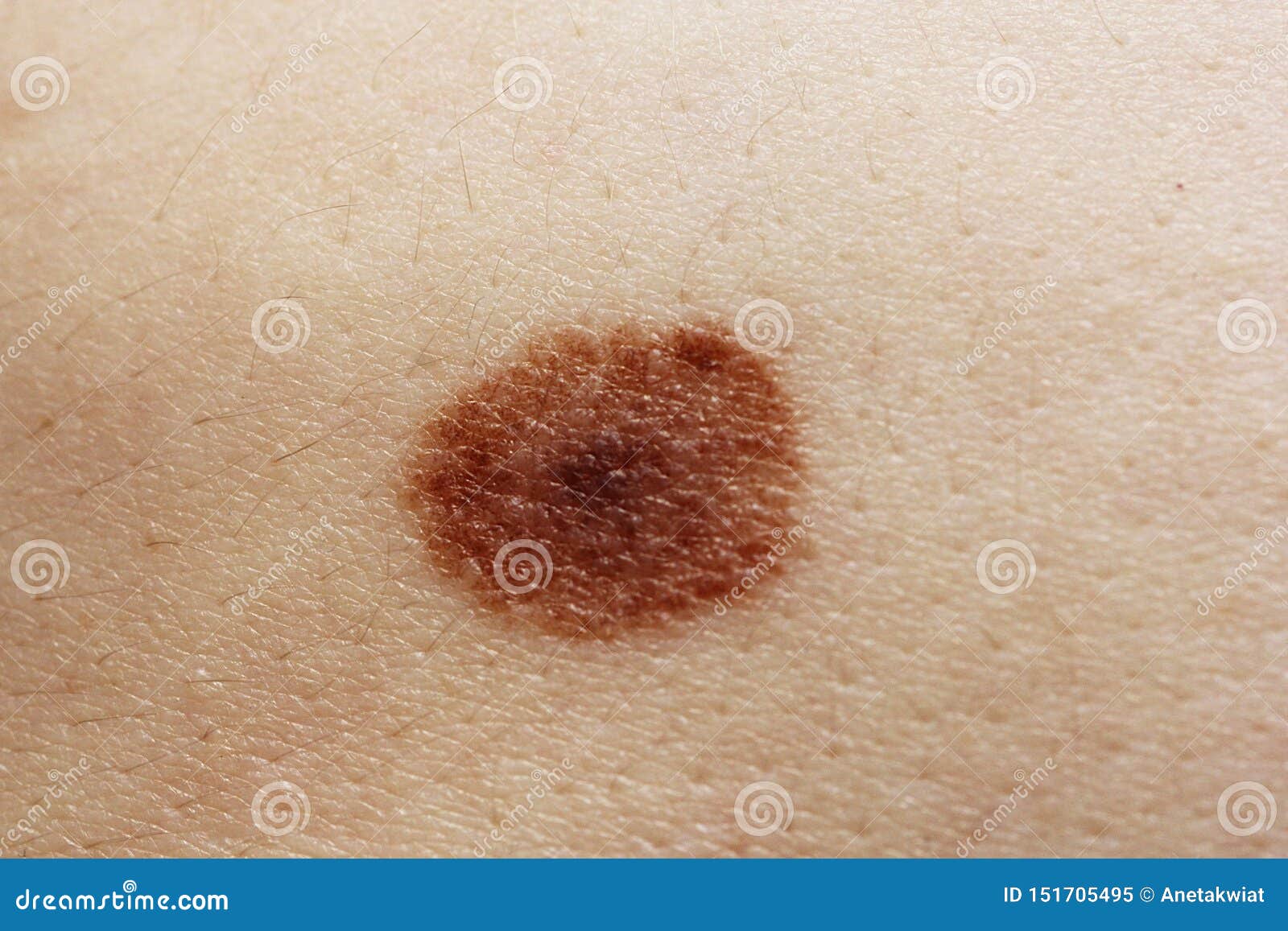 Close Up of Mole on Human Skin Stock Image - Image of dark, closeup ...
