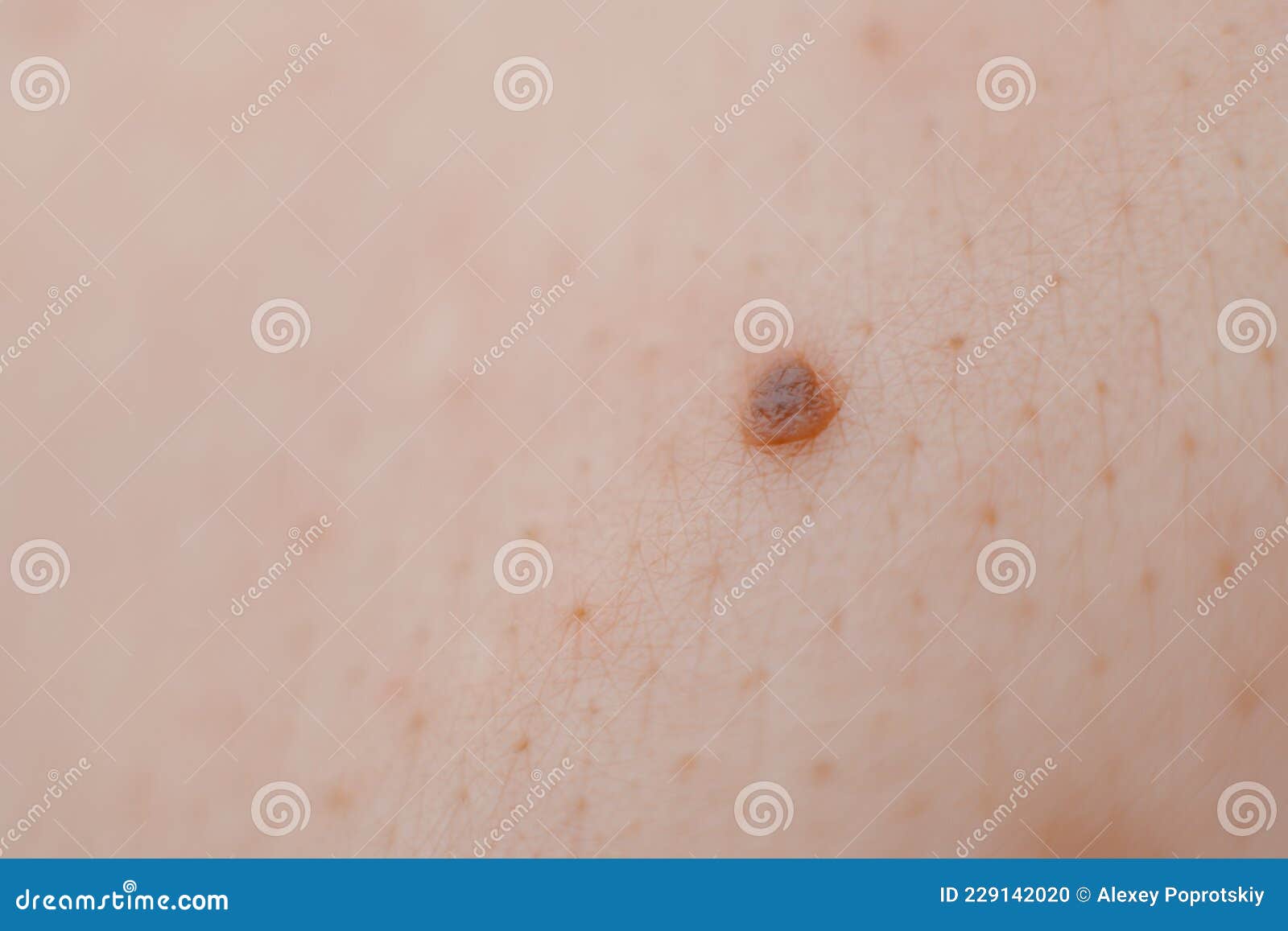 Close Up of Mole and Human Skin Texture. Stock Photo - Image of ...