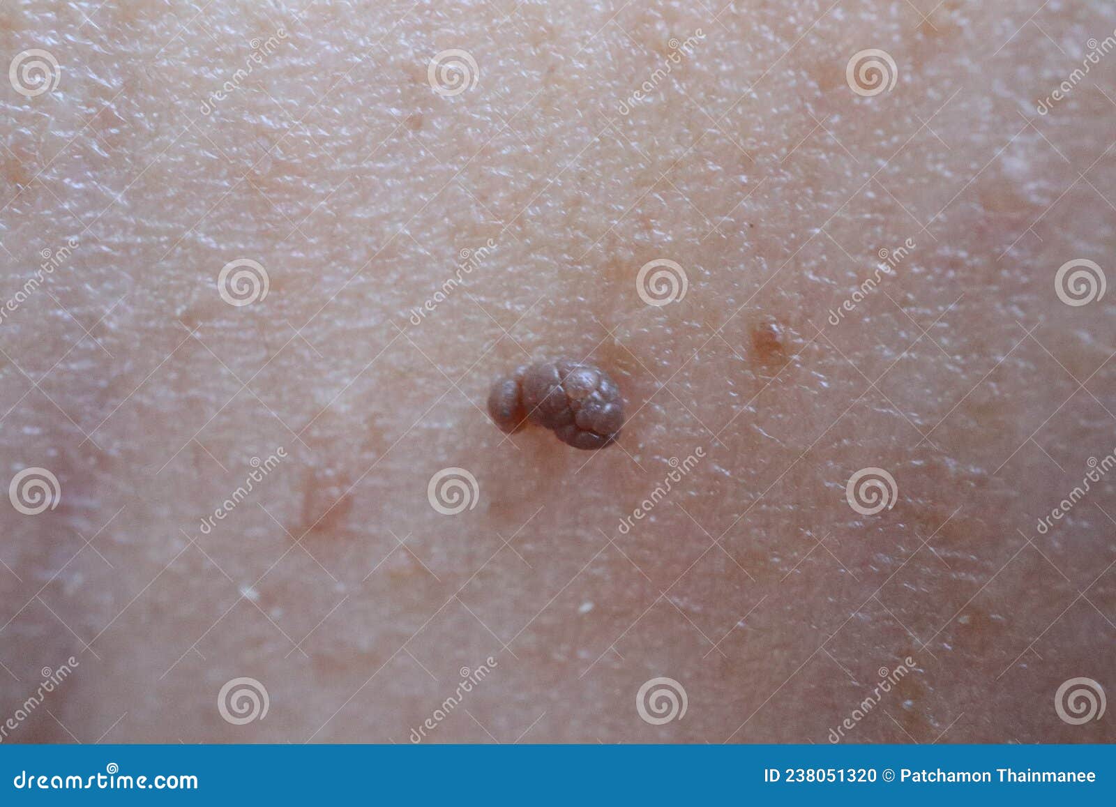 Close-up of a Mole or Polyp on a Young Woman& X27;s Skin Stock Photo ...