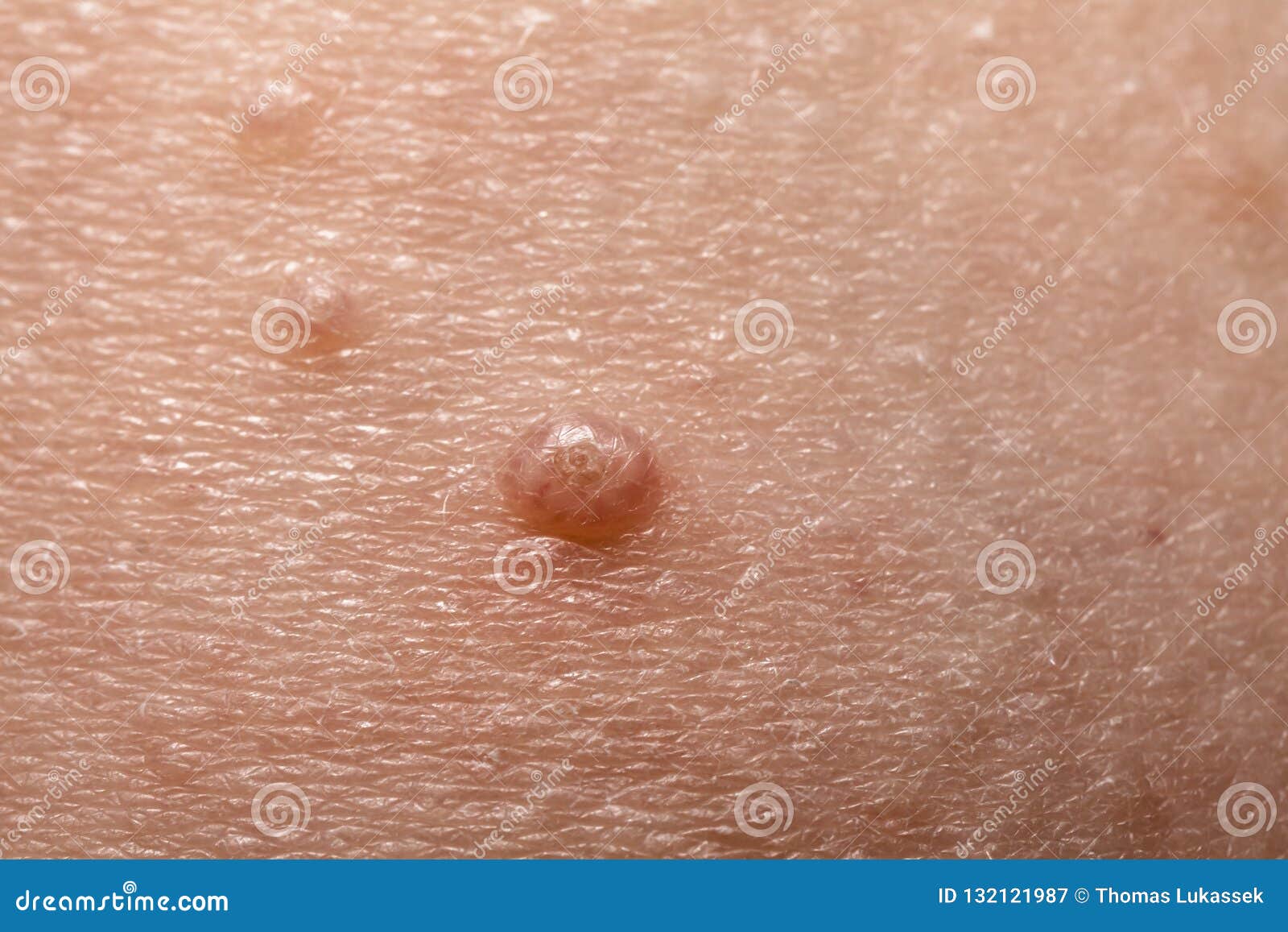 Close Up of Molluscum Contagiosum Also Called Water Wart Stock Image ...