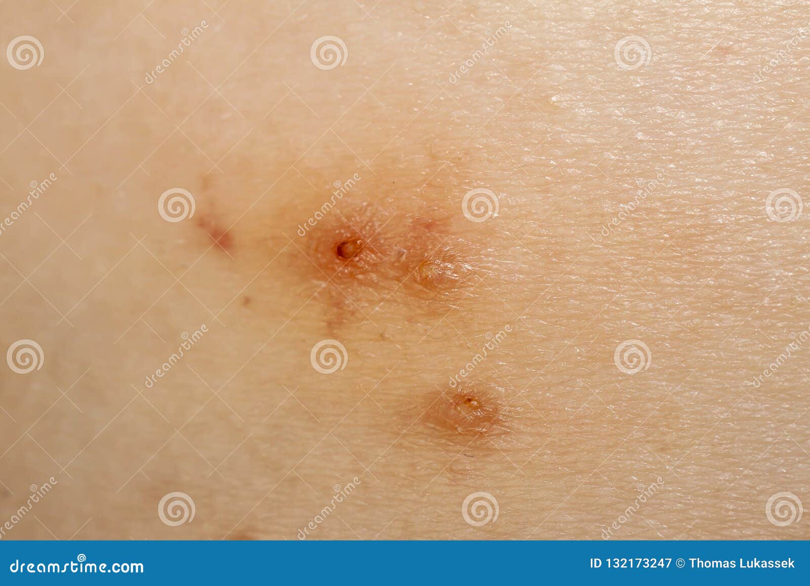 Close Up Of Molluscum Contagiosum Also Called Water Wart Stock Image Image Of Care
