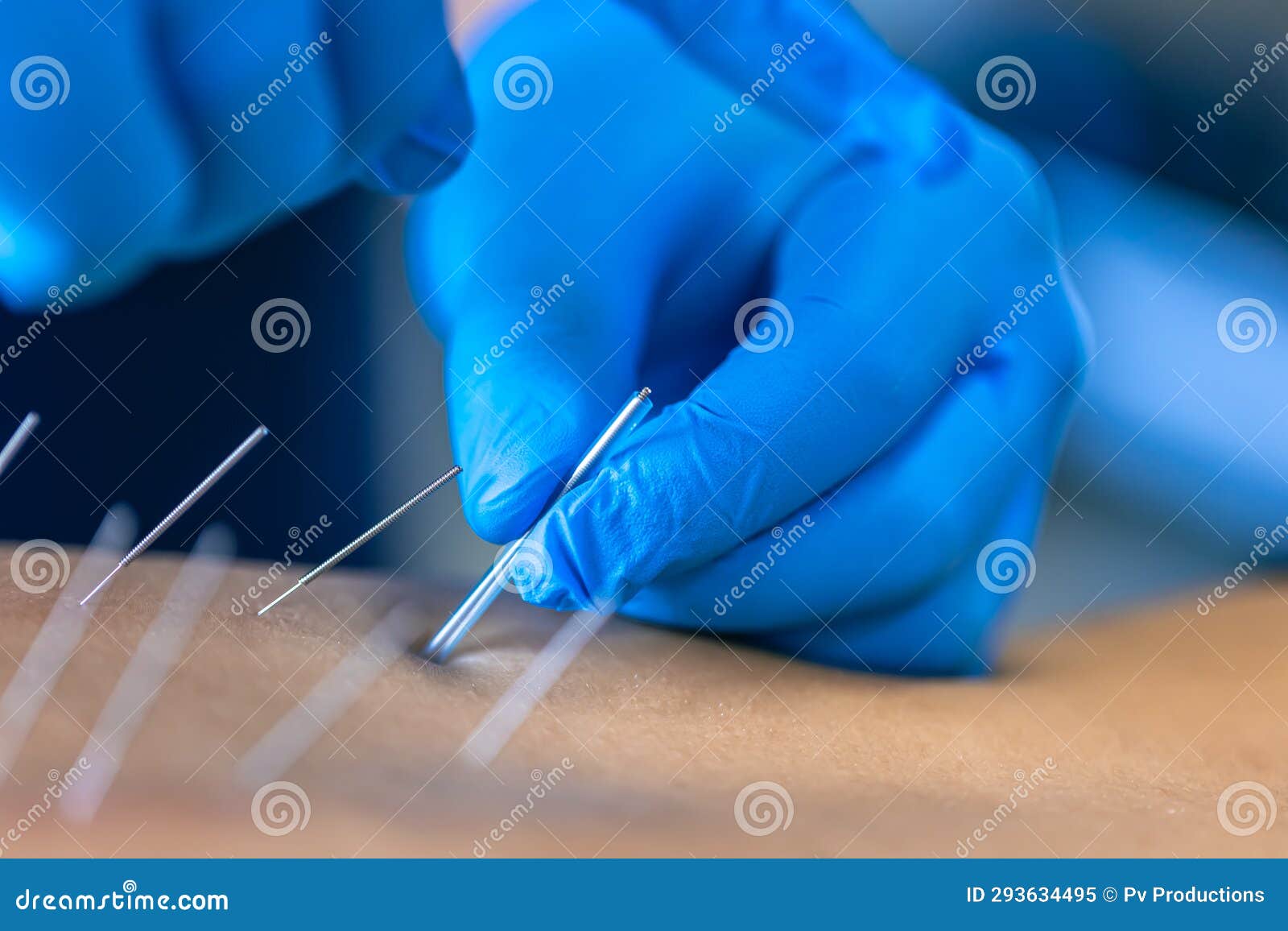 Close Up of a Needle and Hands of Physiotherapist Doing a Dry Needling ...