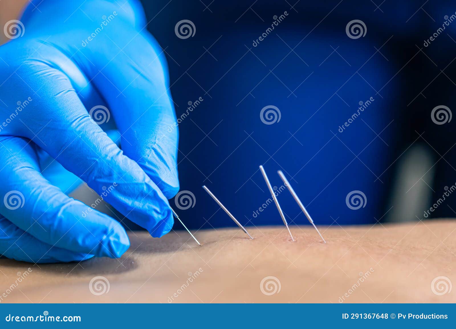 Close Up of a Needle and Hands of Physiotherapist Doing a Dry Needling ...